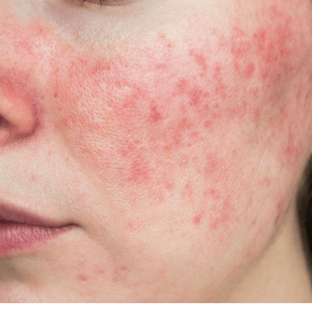 Perioral Dermatit - Rosacea-arkiv - Turkos